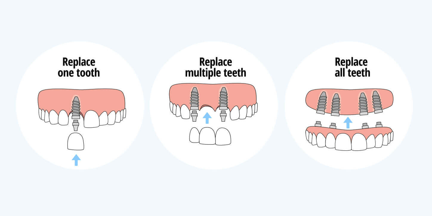 Dental Implant Options: Single, Multiple & Full-Mouth